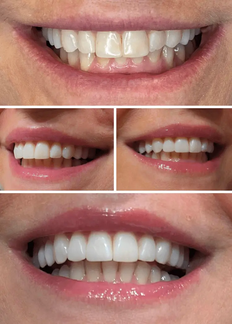 Carillas Composite Inyectadas - Clínica Dental Conde